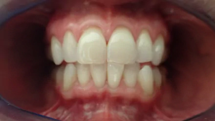 Teeth - Desktop Wallpapers, Phone Wallpaper, PFP, Gifs, and More!